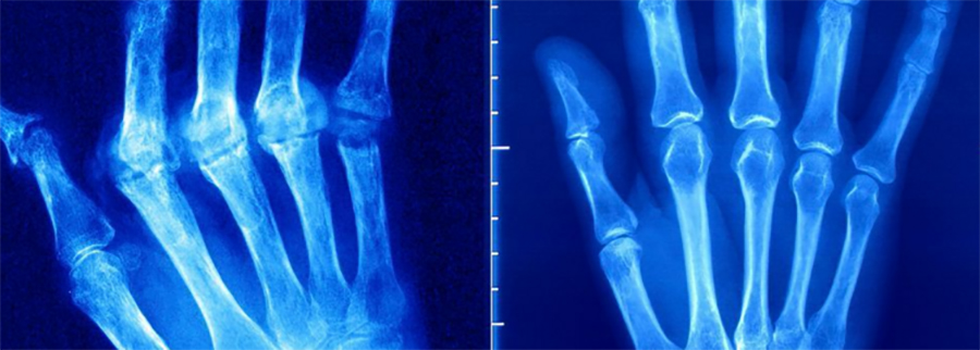 Op zoek naar de remedie voor reuma - Universiteit Leiden